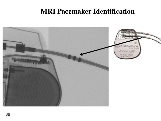 Ai Can Improve Xray Identification Of Pacemakers In