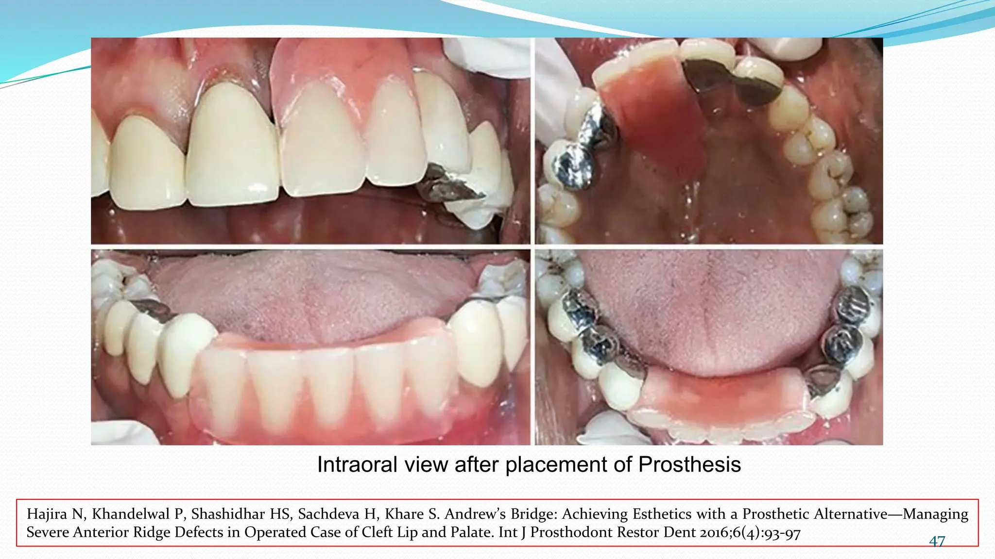 GROWTH AND DEVELOPMENT OF MAXILA 16.pptx