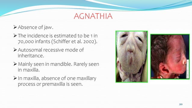 GROWTH AND DEVELOPMENT OF MAXILA 16.pptx