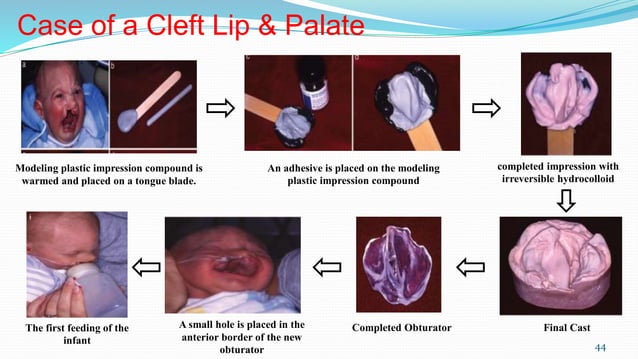 GROWTH AND DEVELOPMENT OF MAXILA 16.pptx