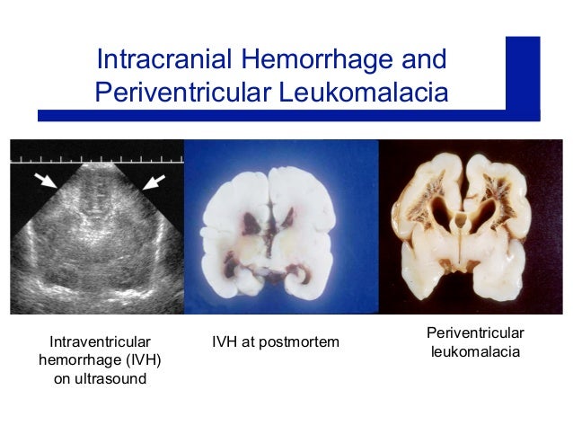 Care of the Extremely Preterm Baby