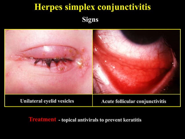 09Conjunctival Infections.ppt