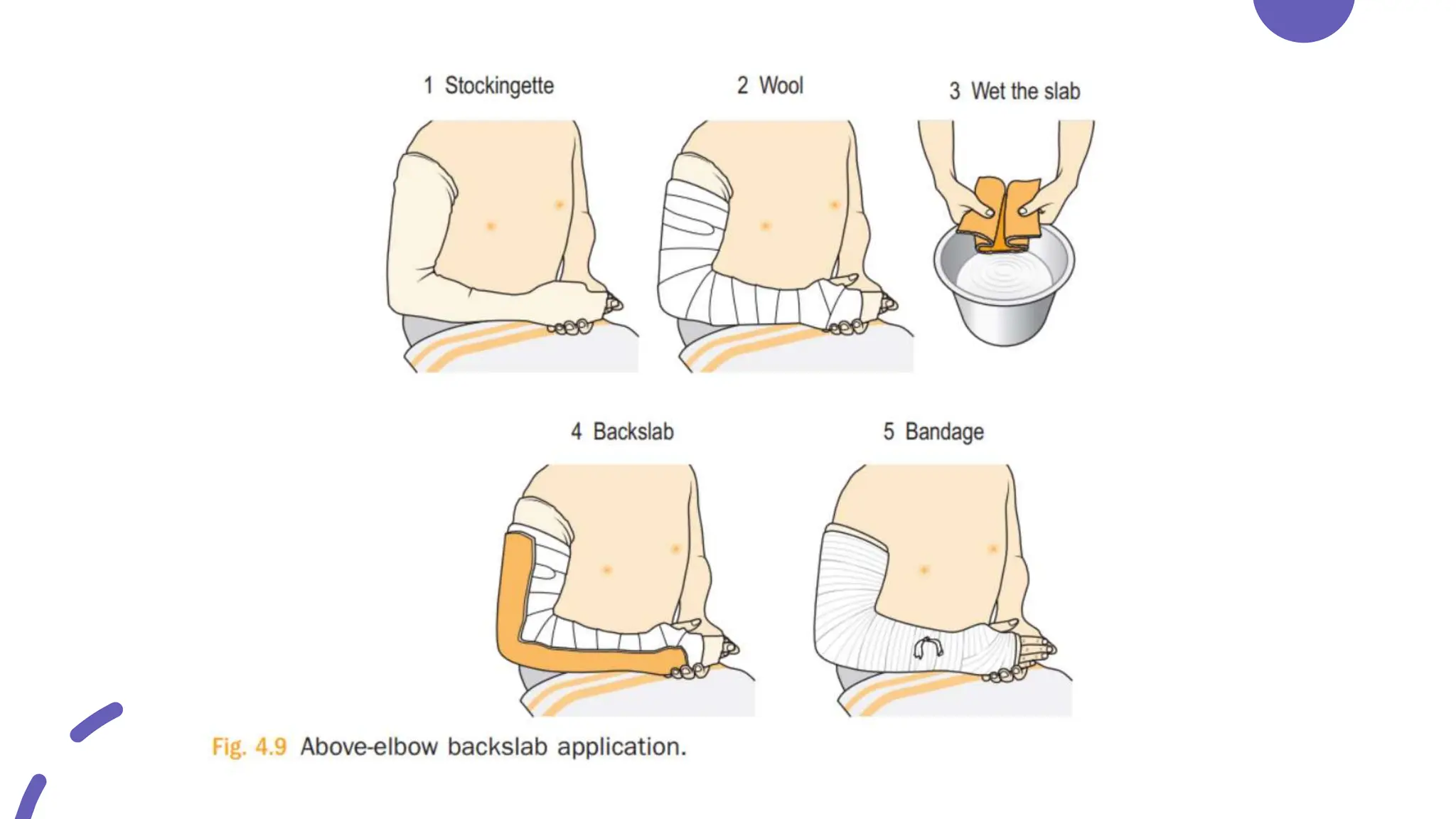 above elbow backstab as seen in adlt.pptx