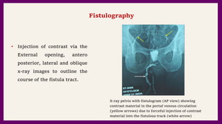 09 Dr.Kannan Fistula in ano chennai (21-07-2023) Final.pptx