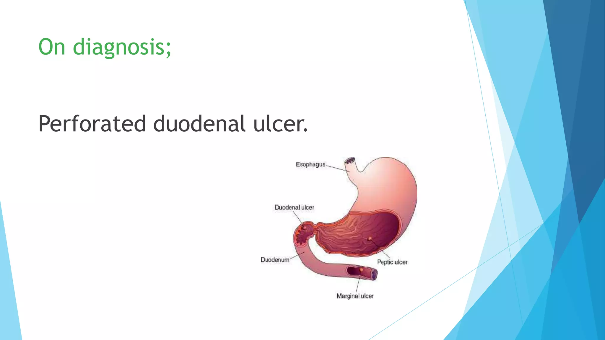 Case Presentation on Perforated Duodenal Ulcer | PPTX