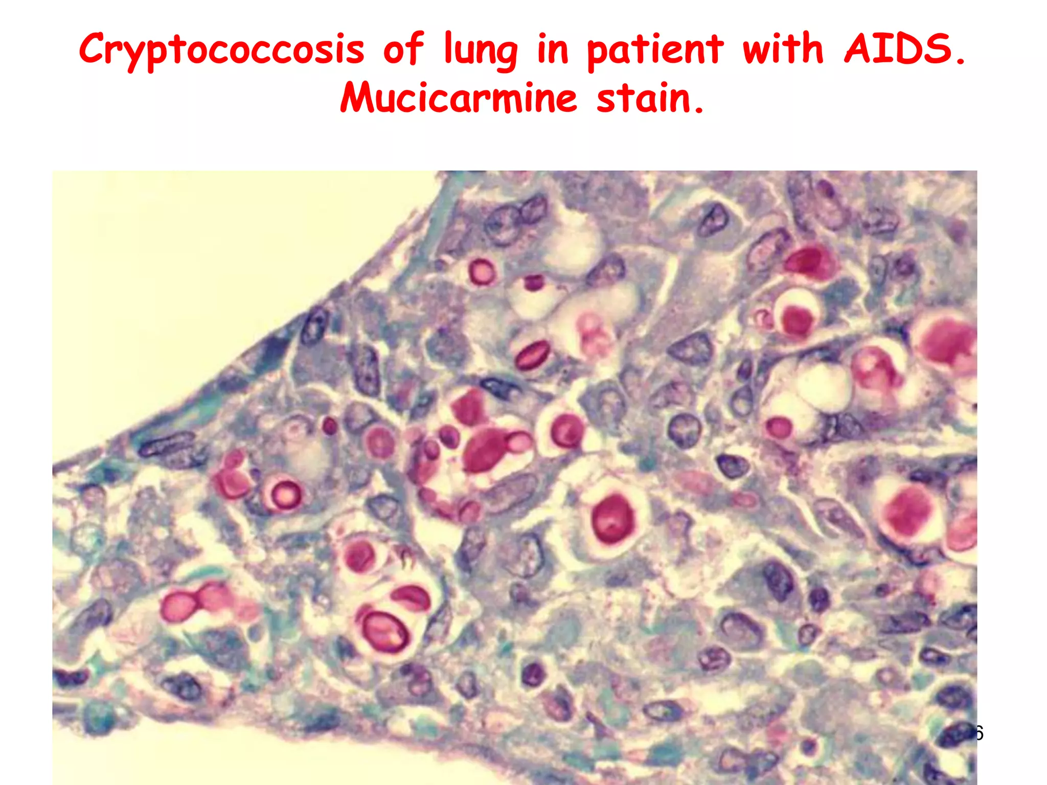 09 infectious disease Fungal infections | PPT