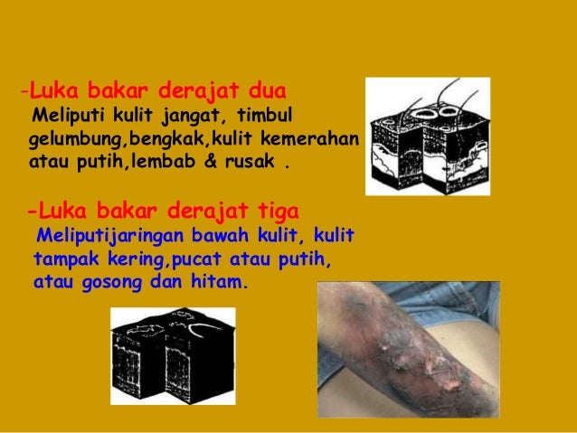 penanganan luka bakar