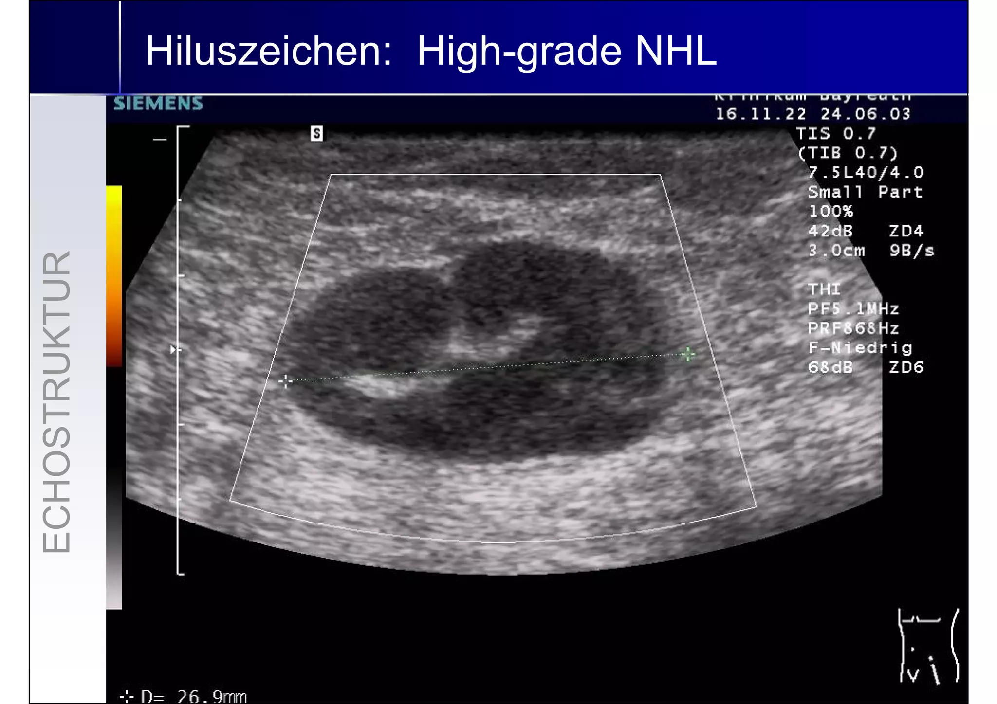 09 Lymphknotensonographie 2. Sonographietechnik der akuten ...