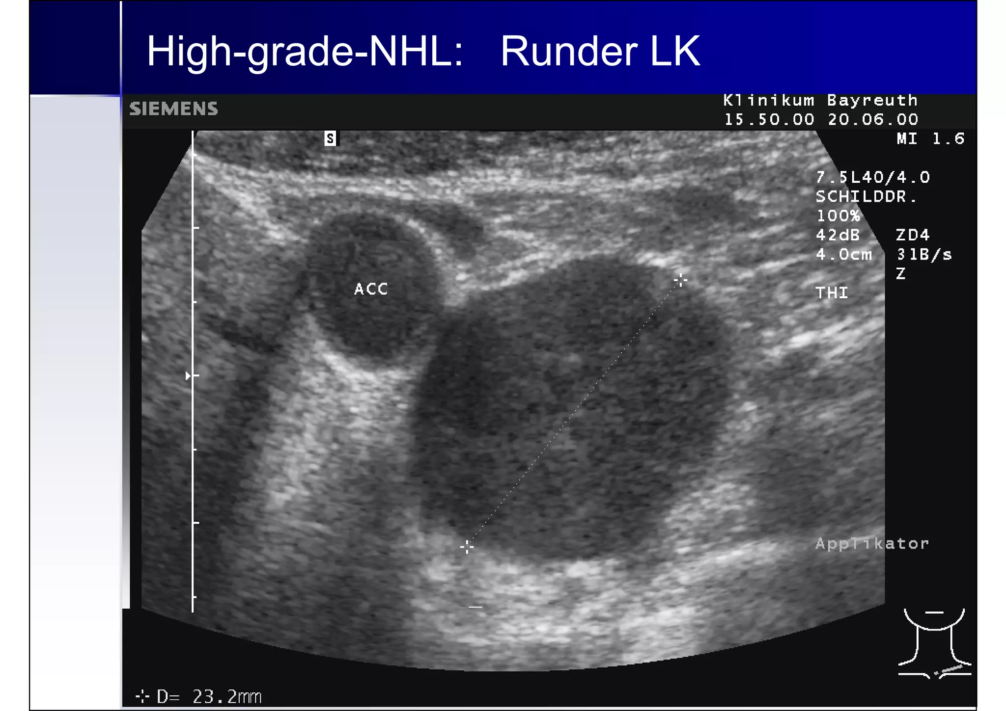 09 Lymphknotensonographie 2. Sonographietechnik der akuten Lymphknote…