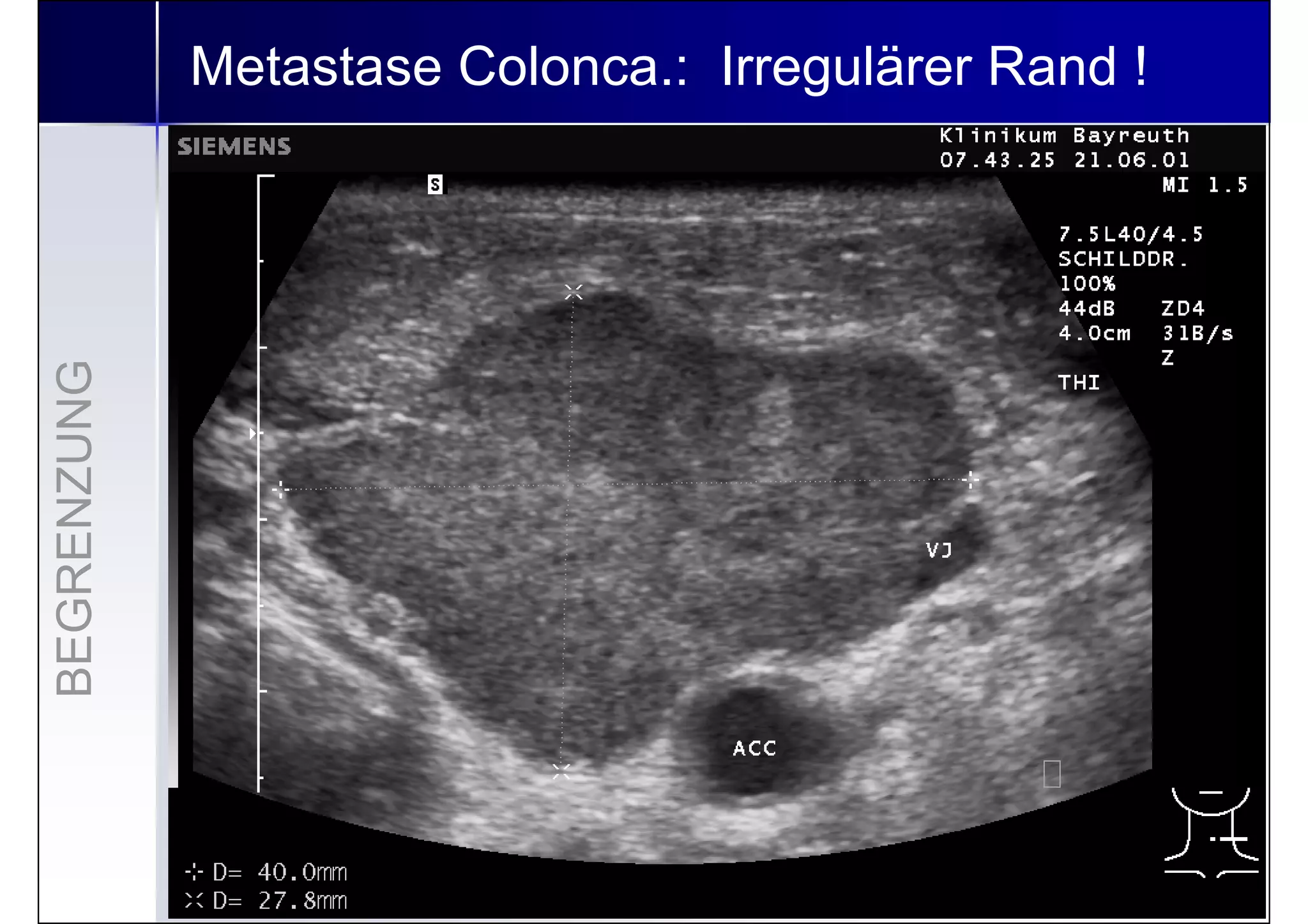 09 Lymphknotensonographie 2. Sonographietechnik der akuten Lymphknote…