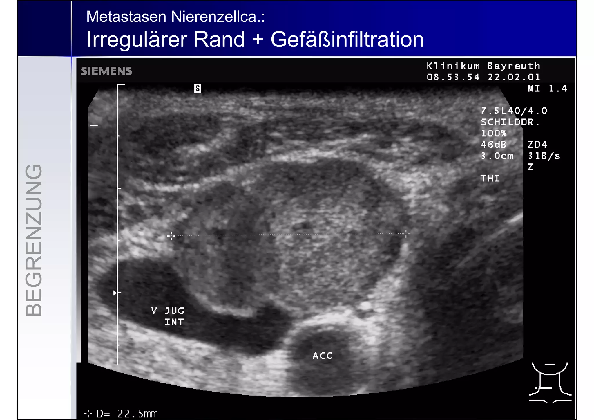09 Lymphknotensonographie 2. Sonographietechnik der akuten Lymphknote…
