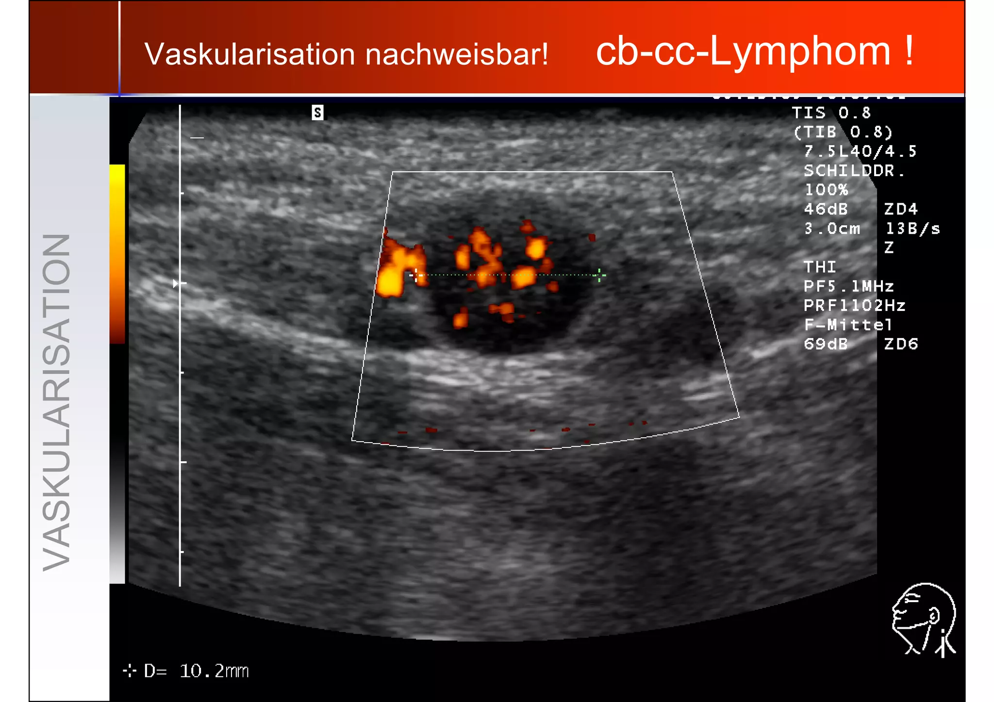 09 Lymphknotensonographie 2. Sonographietechnik der akuten Lymphknote…
