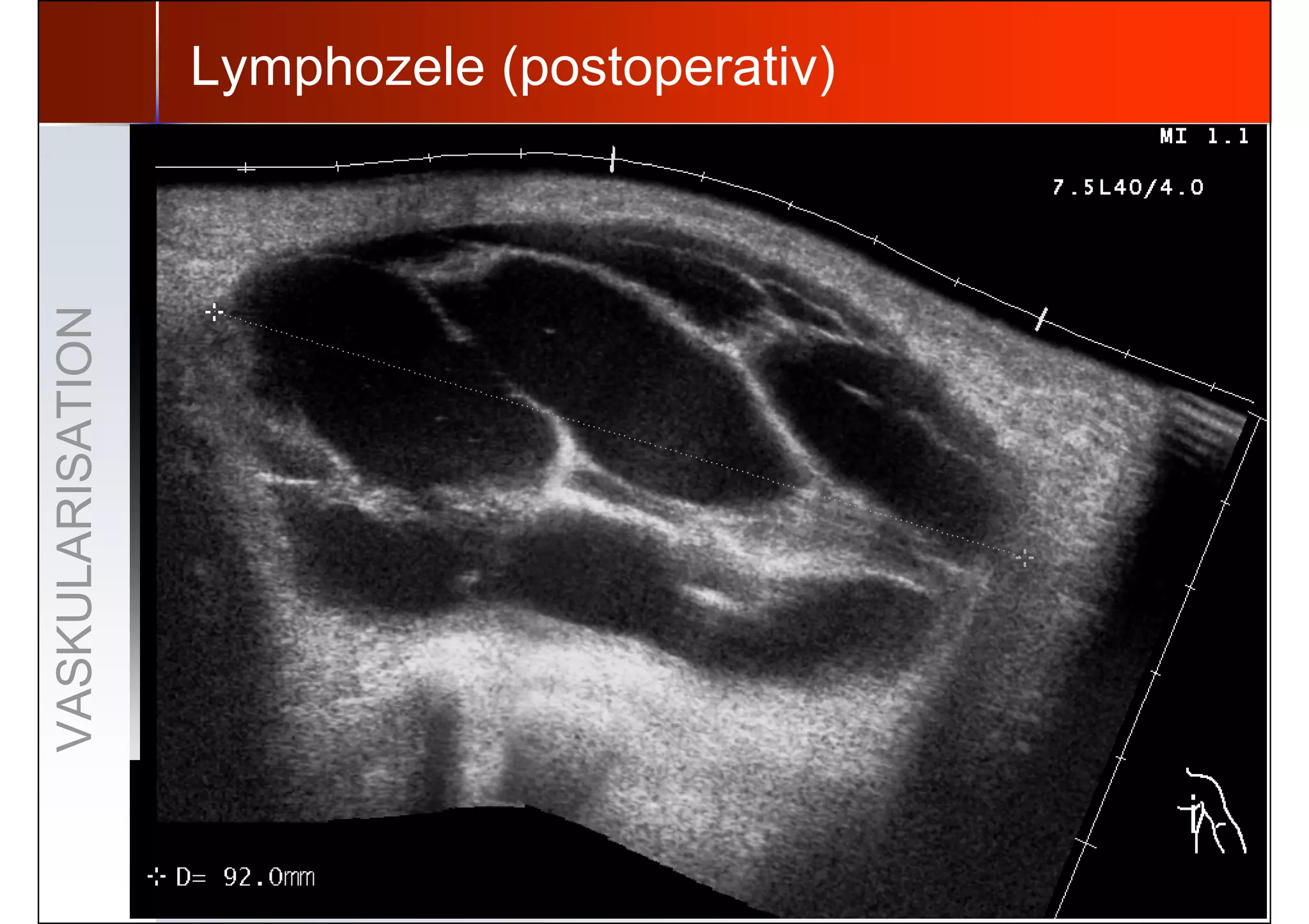 09 Lymphknotensonographie 2. Sonographietechnik der akuten Lymphknote…