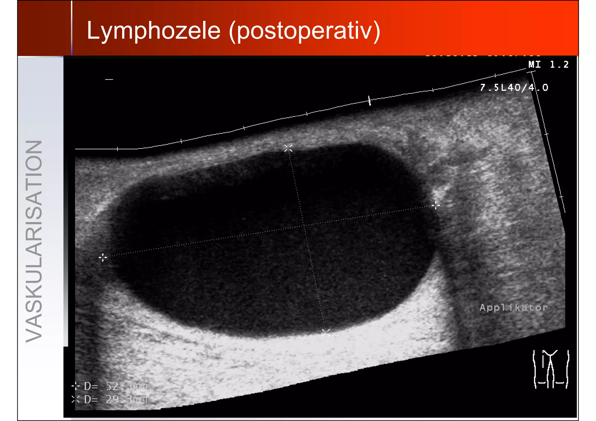 09 Lymphknotensonographie 2. Sonographietechnik der akuten Lymphknote…