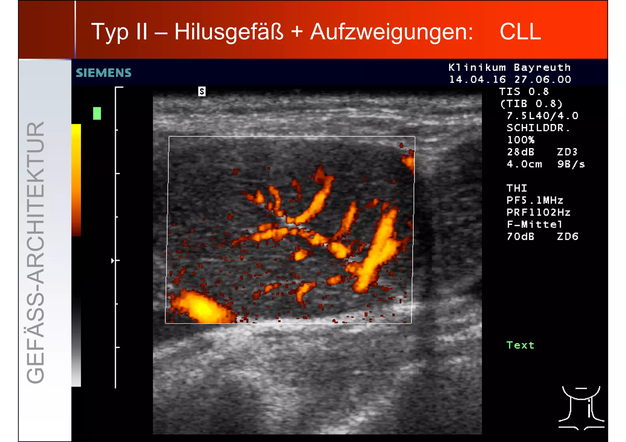 09 Lymphknotensonographie 2. Sonographietechnik der akuten Lymphknote…