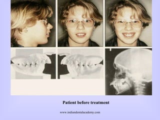 PG retraction spring for canine & incisor /certified fixed orthodontic ...