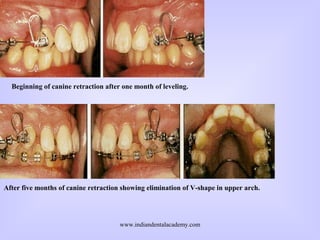 PG retraction spring for canine & incisor /certified fixed orthodontic ...