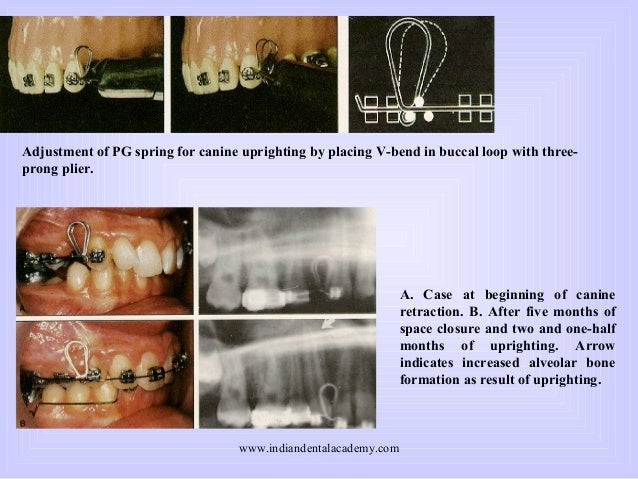 PG retraction spring for canine & incisor /certified fixed orthodo…