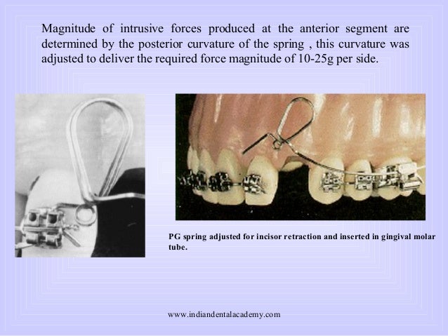 PG retraction spring for canine & incisor /certified fixed orthodo…