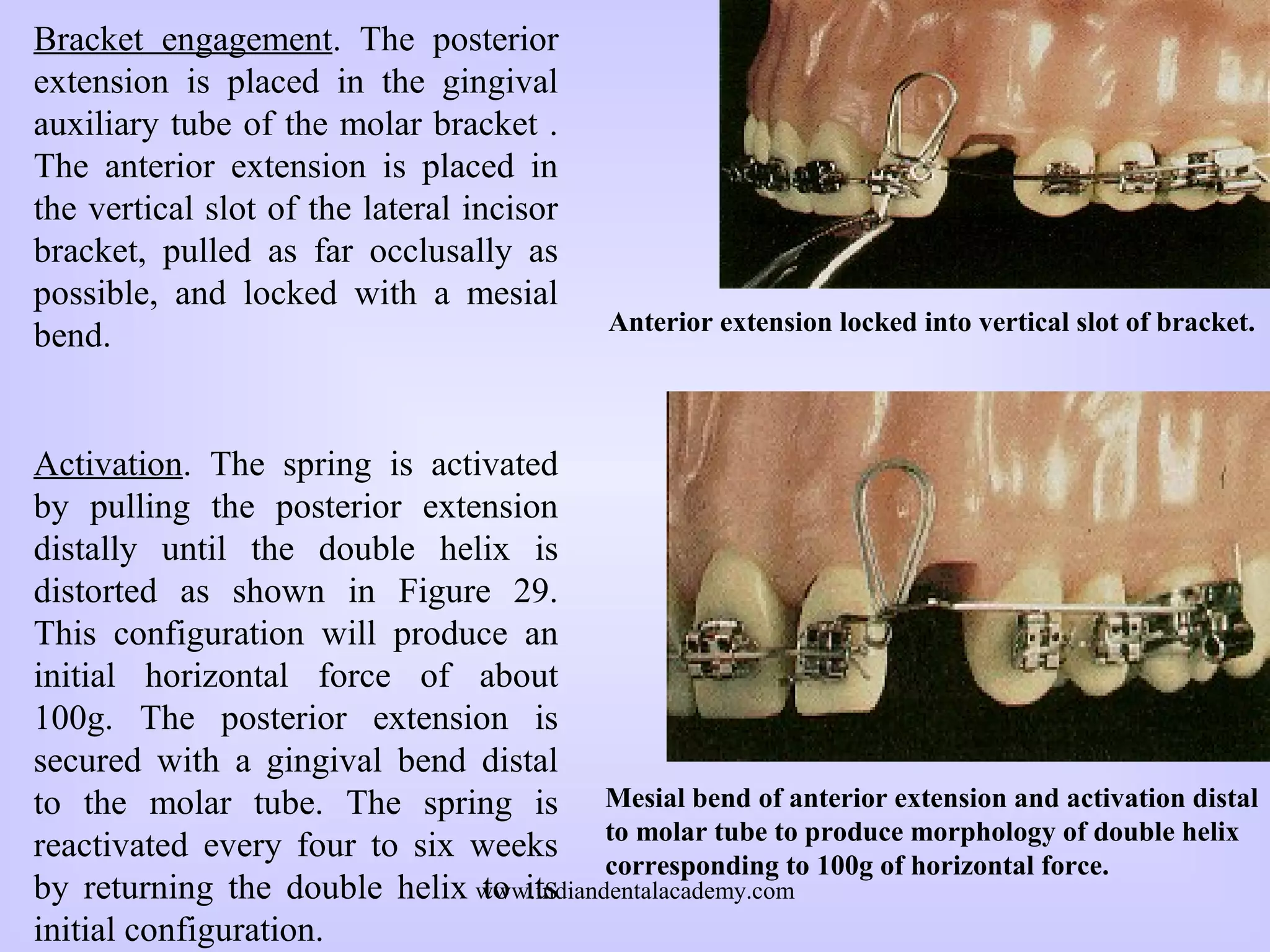 09 pg retraction spring for canine & incisor | PPT