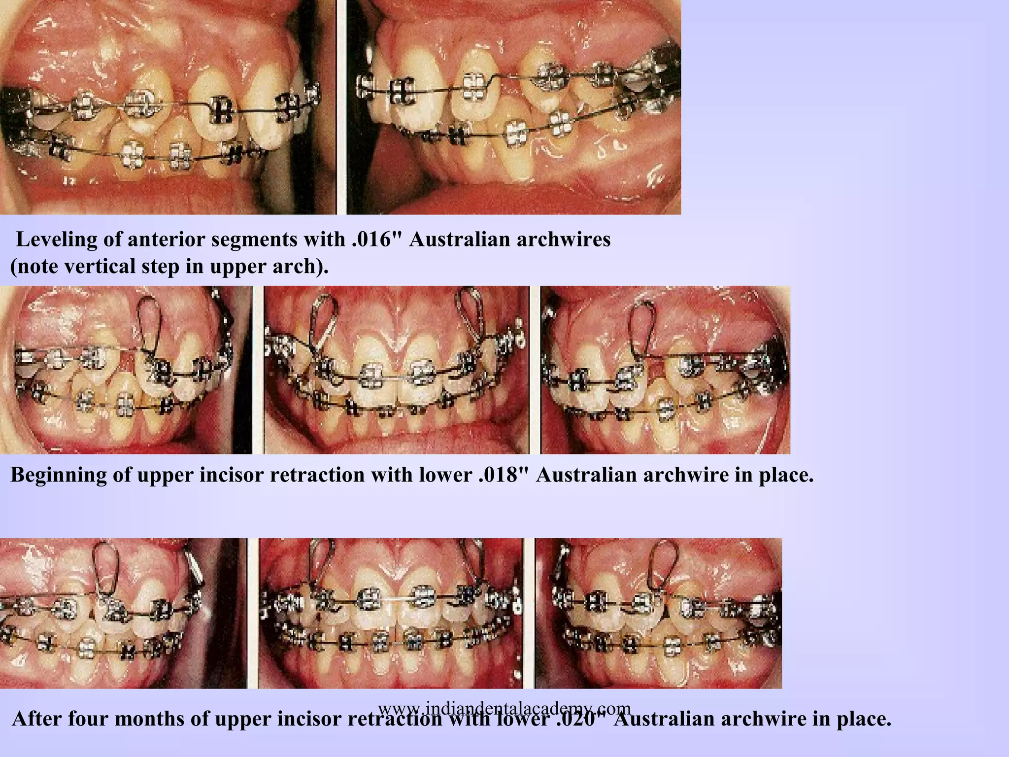 09 pg retraction spring for canine & incisor | PPT