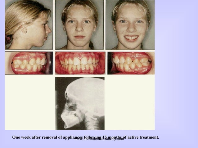 09 pg retraction spring for canine & incisor | PPT