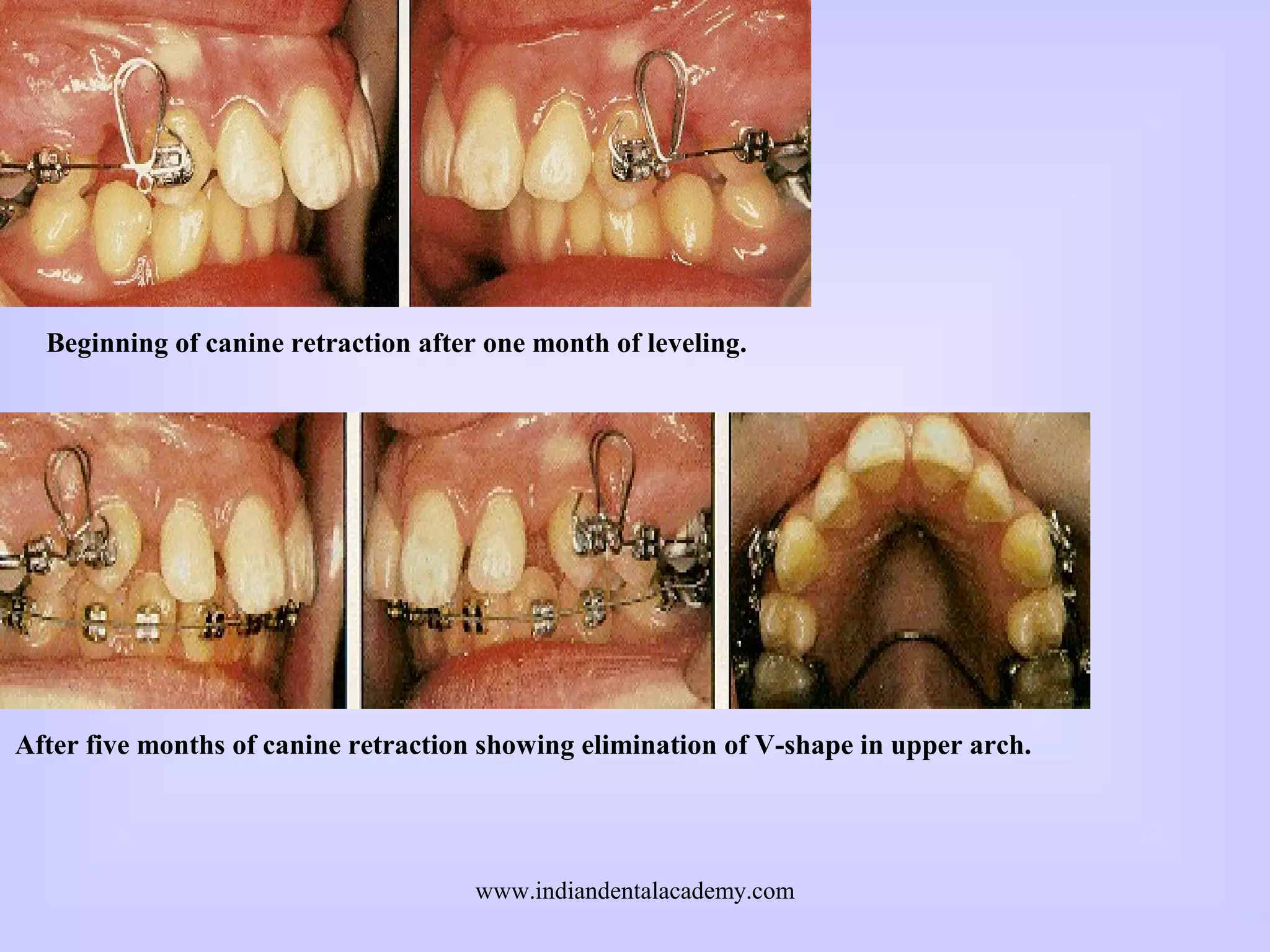 PG Retraction Spring for Canine & Incisor /certified fixed orthodontic ...