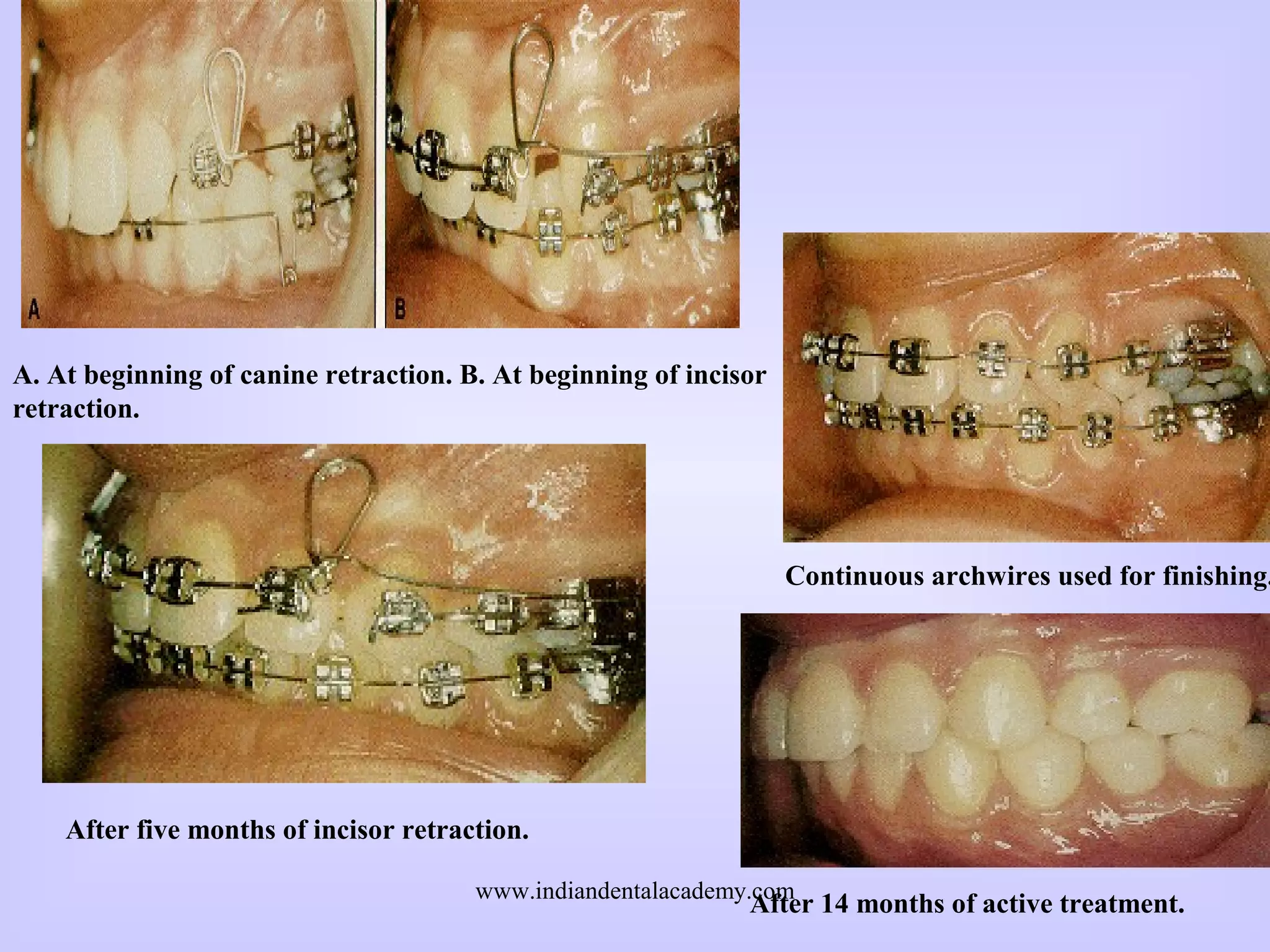 PG Retraction Spring for Canine & Incisor /certified fixed orthodontic ...