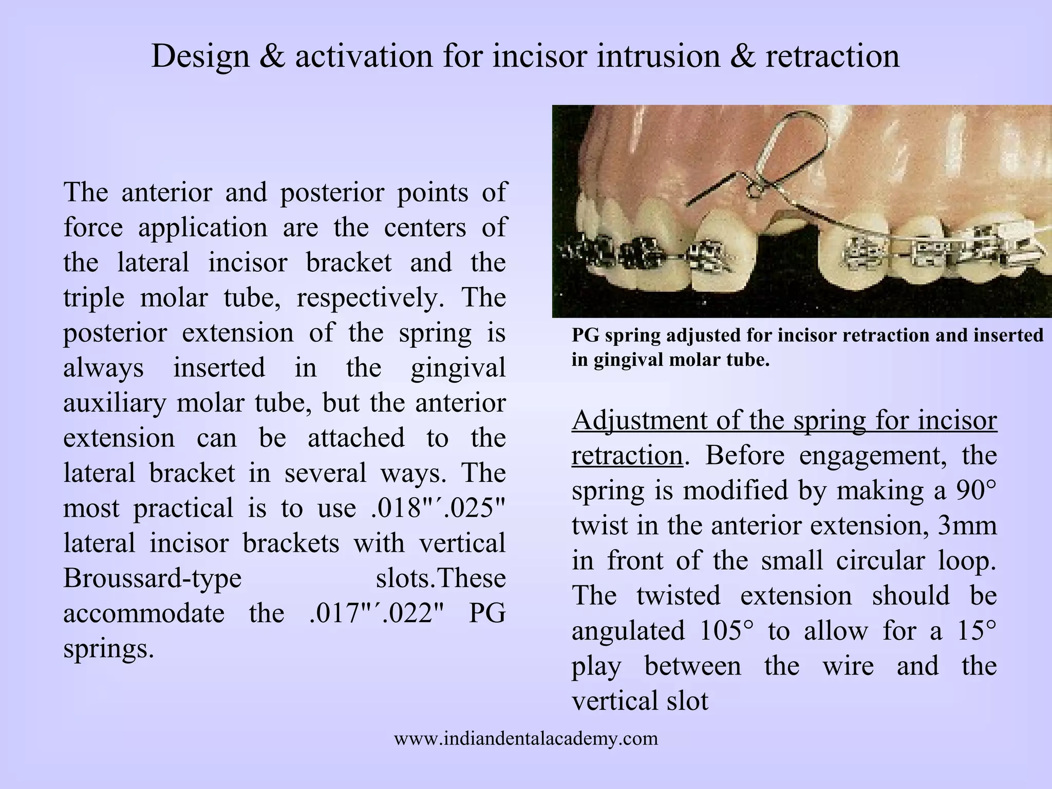 PG Retraction Spring for Canine & Incisor /certified fixed orthodontic ...