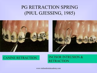 PG Retraction Spring for Canine & Incisor /certified fixed orthodontic ...