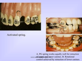 PG Retraction Spring for Canine & Incisor /certified fixed orthodontic ...