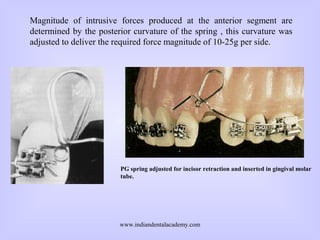 PG Retraction Spring for Canine & Incisor /certified fixed orthodontic ...
