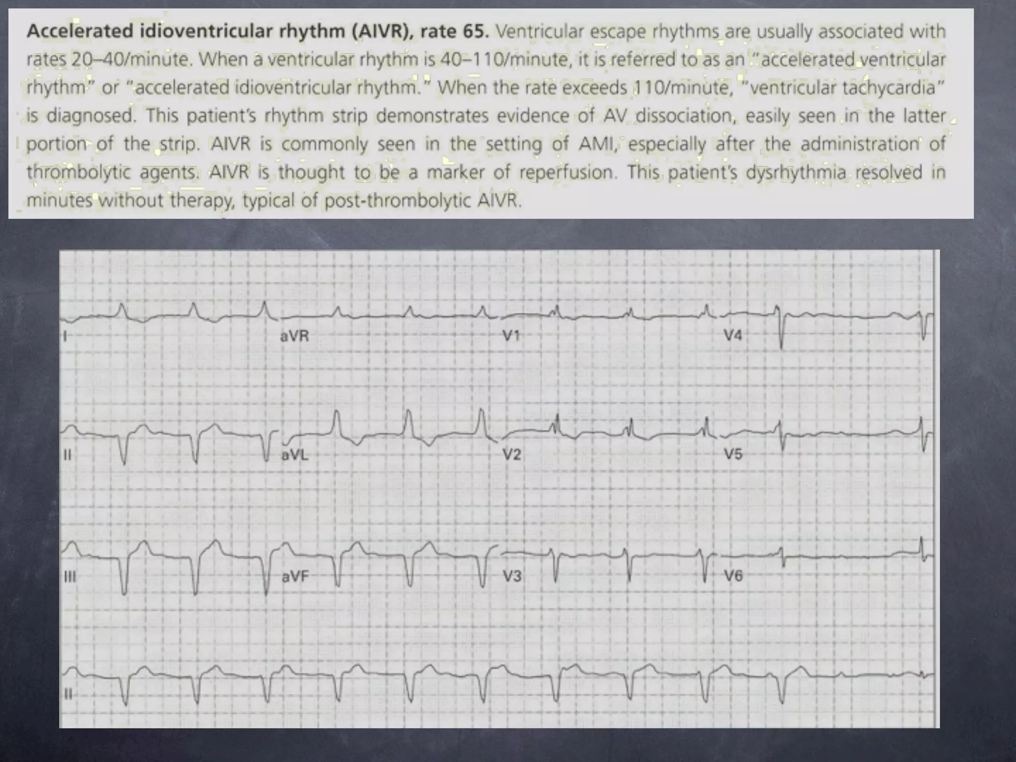 Acute CHF & Aortic Disasters | KEY