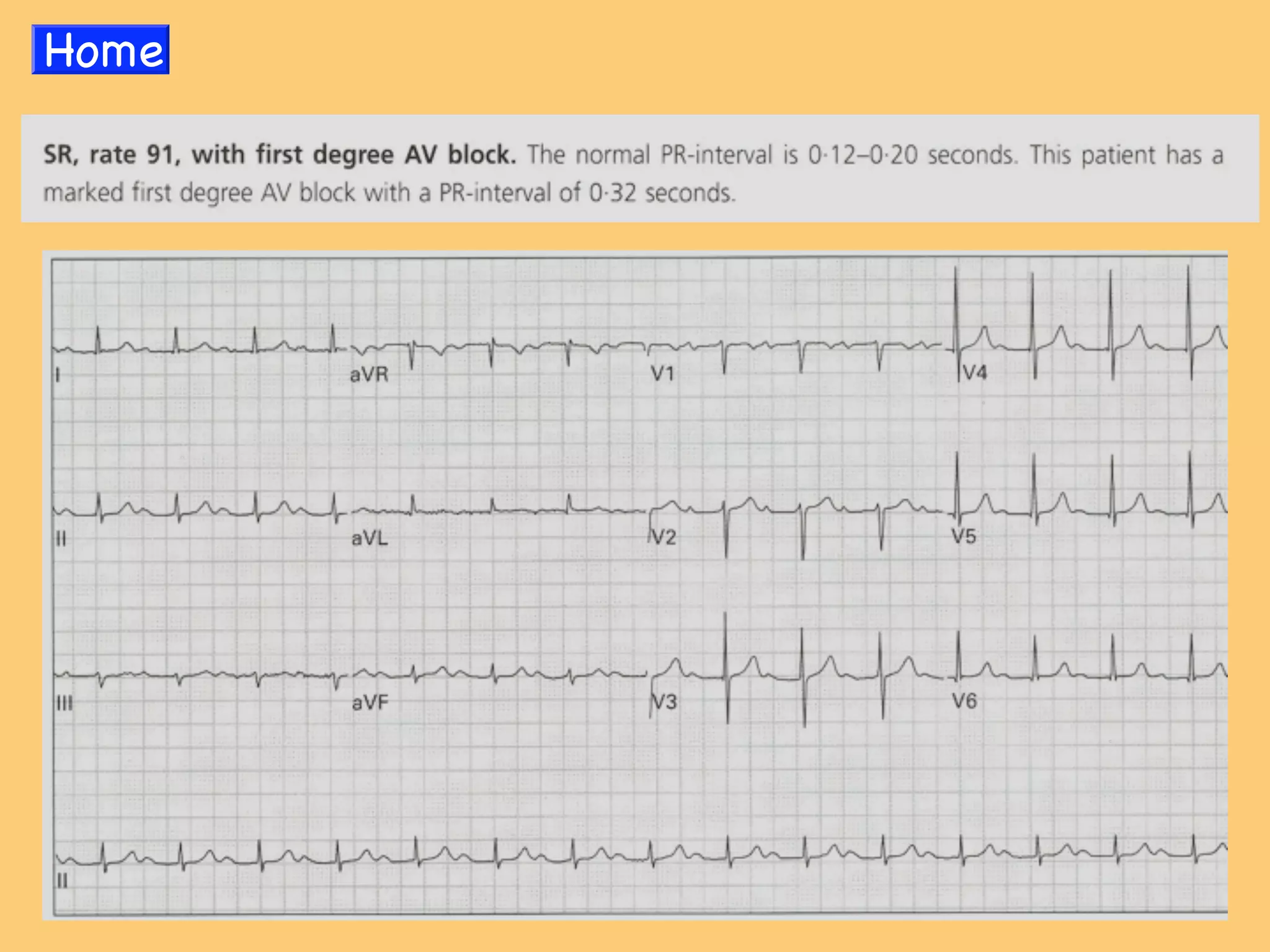 Acute CHF & Aortic Disasters | KEY
