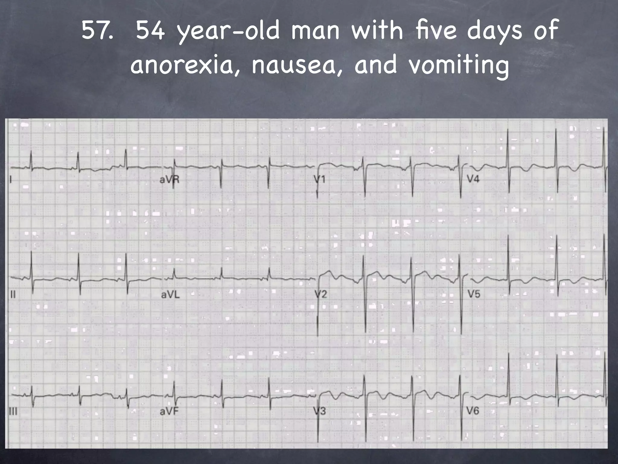 Acute CHF & Aortic Disasters | KEY