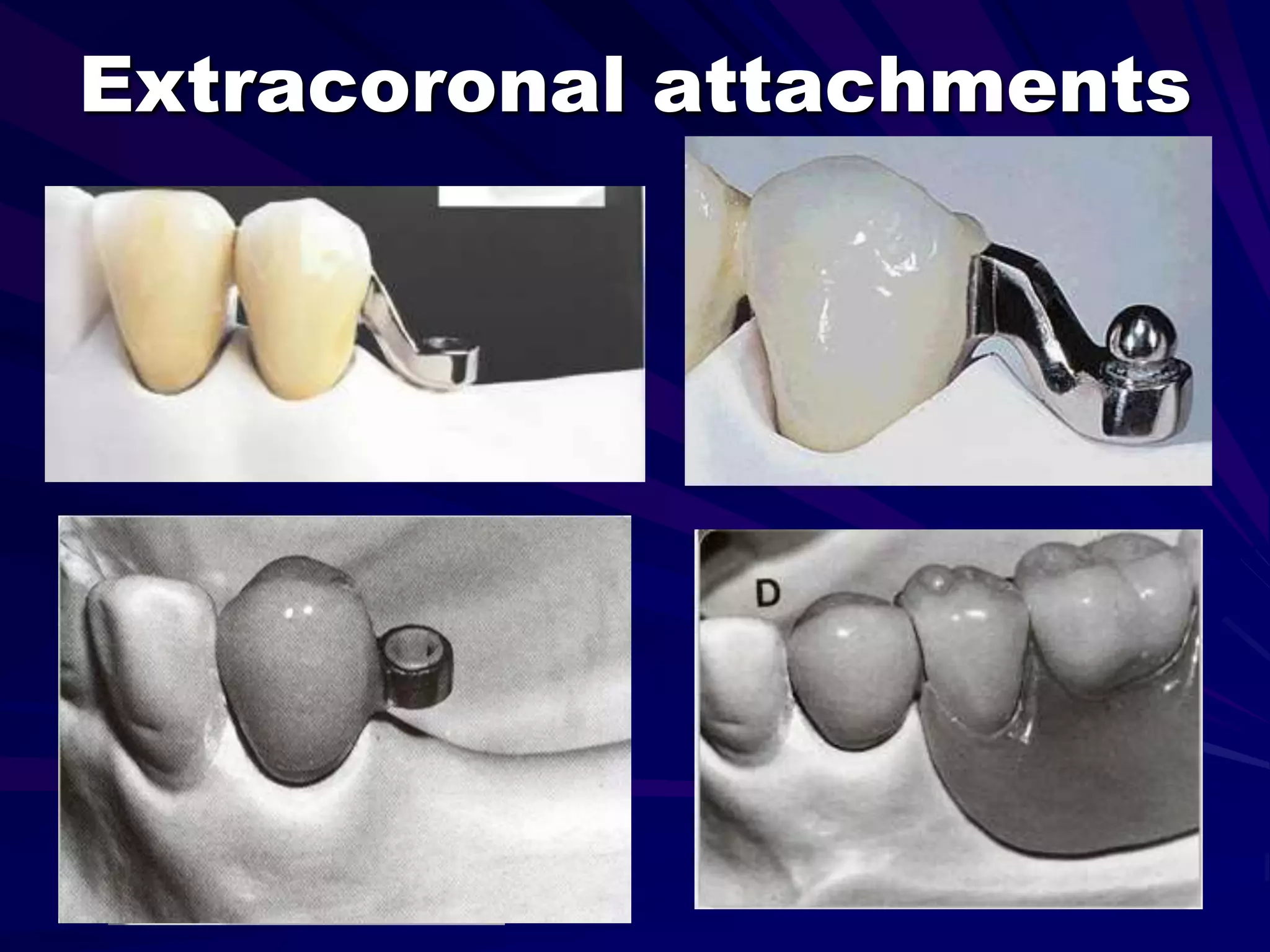 A- Retention of Removable Partial Dentures | PPT