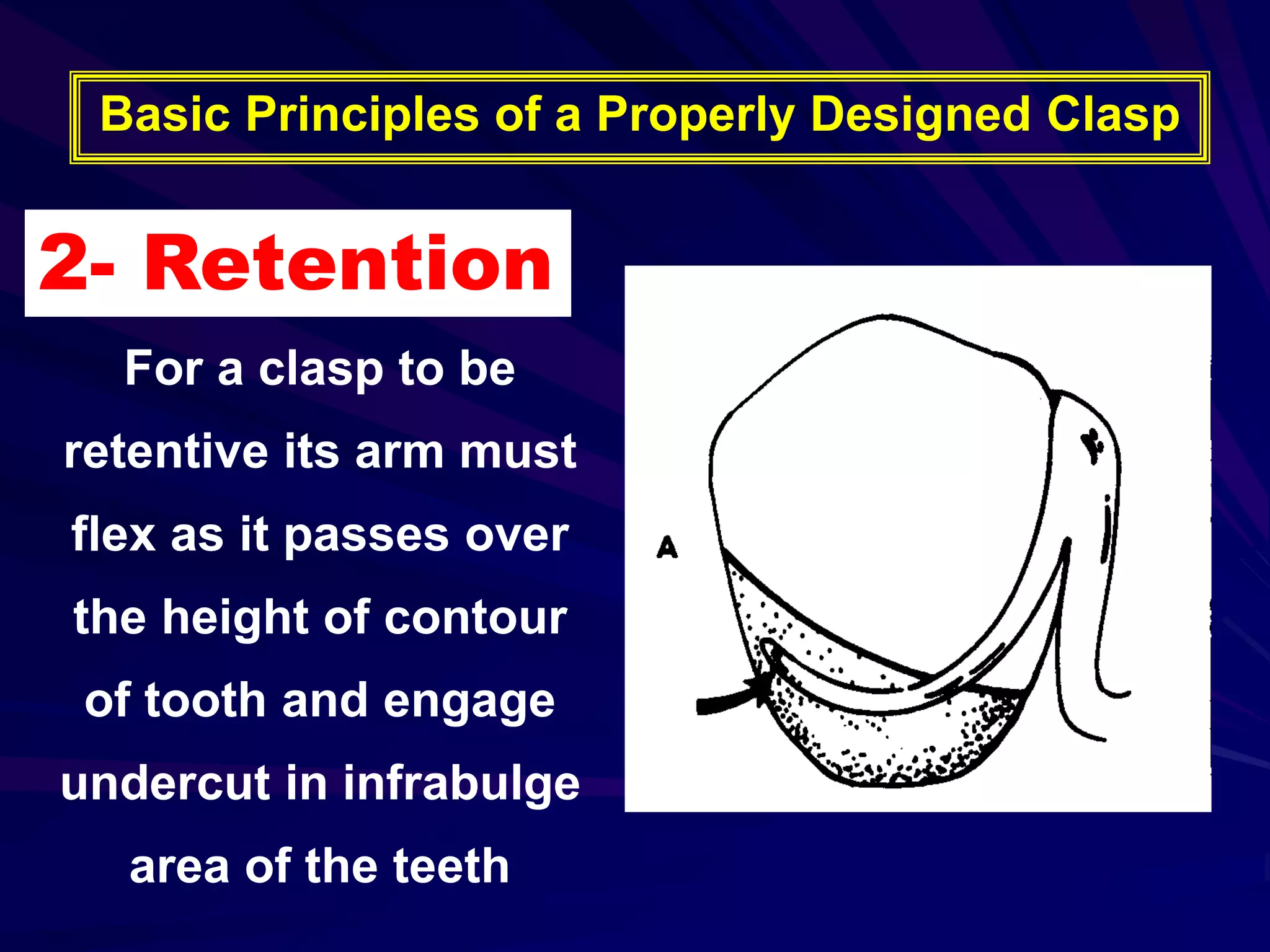A- Retention of Removable Partial Dentures | PPT