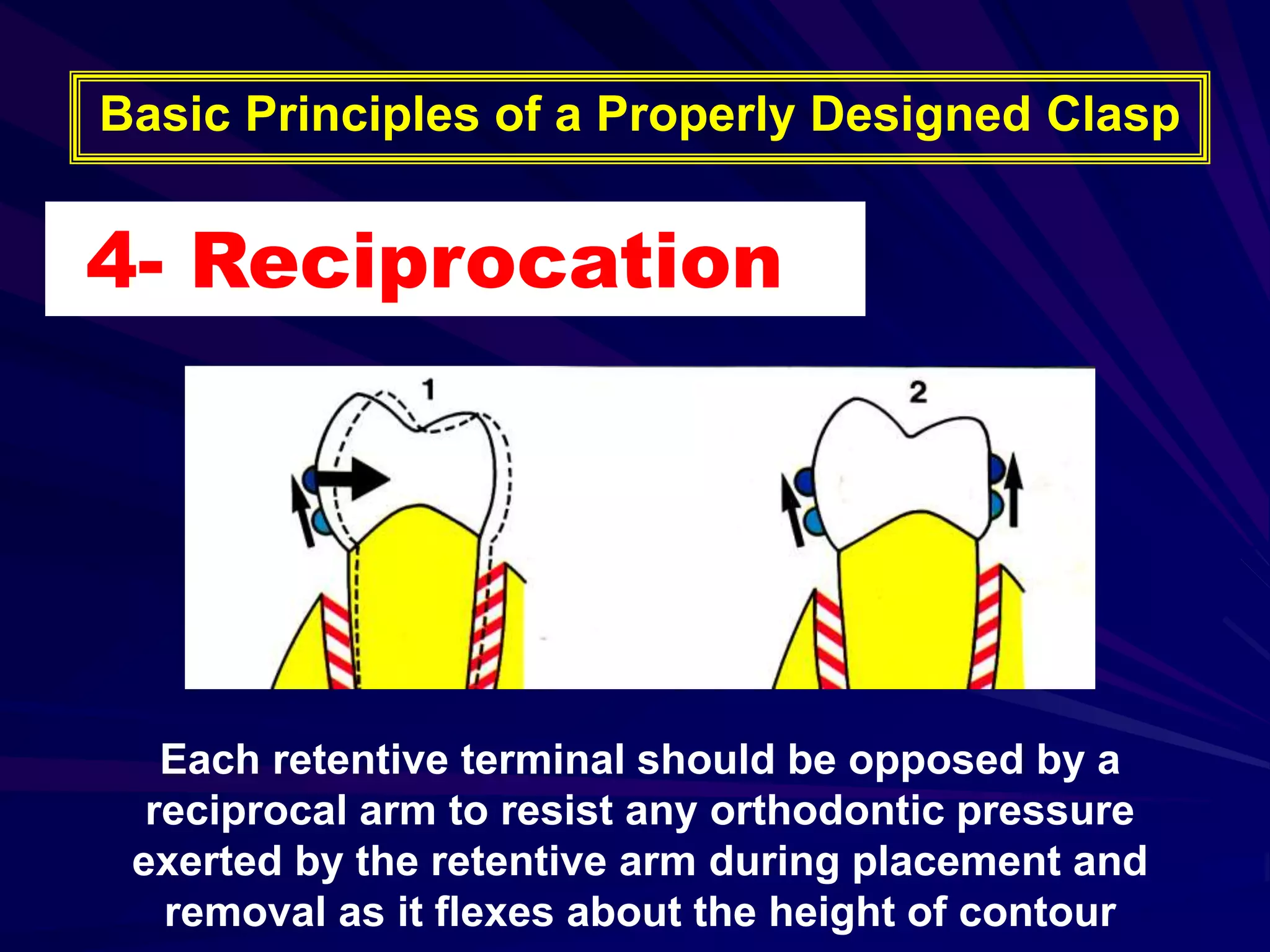 A- Retention of Removable Partial Dentures | PPT