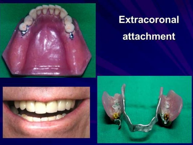 A- Retention of Removable Partial Dentures | PPT