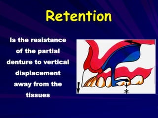 A- Retention of Removable Partial Dentures | PPT