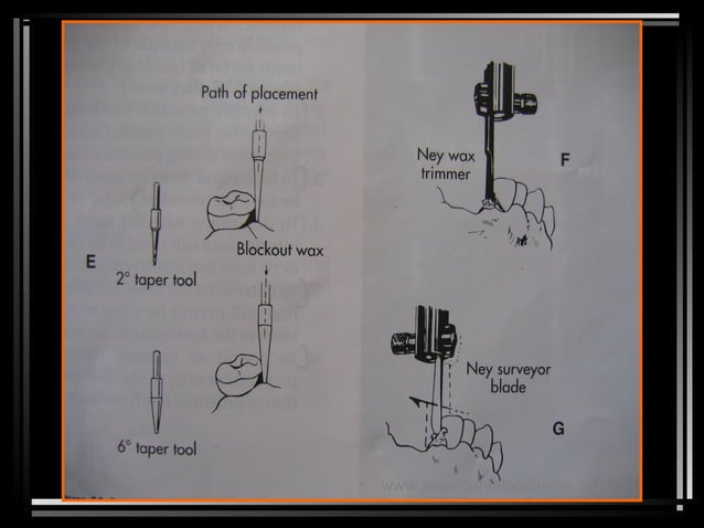 surveyors in Removable partial Dentures/RPD | PPT | Dental Health ...