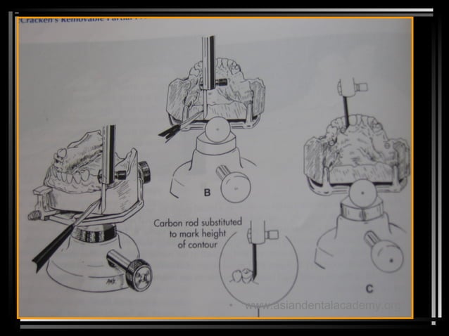 surveyors in Removable partial Dentures/RPD | PPT | Dental Health ...