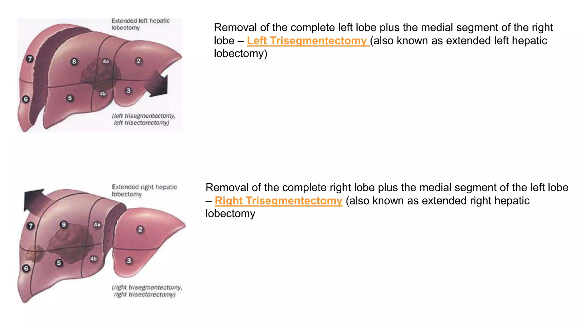 MANAGEMENT OF HEPATOCELLULAR CARCINOMA | PPTX