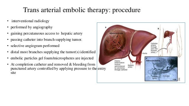 MANAGEMENT OF HEPATOCELLULAR CARCINOMA