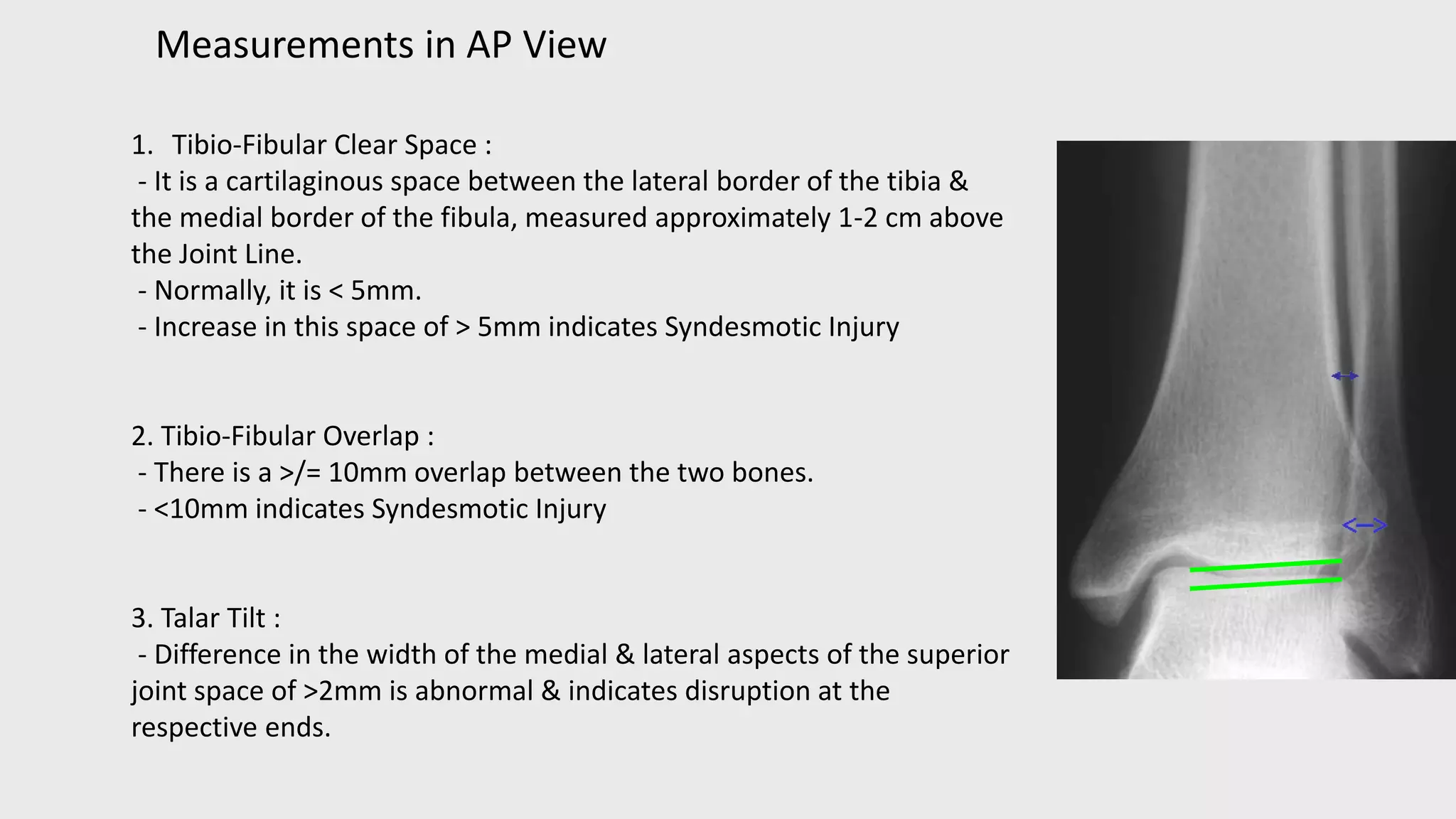 Ankle Fractures.pptx