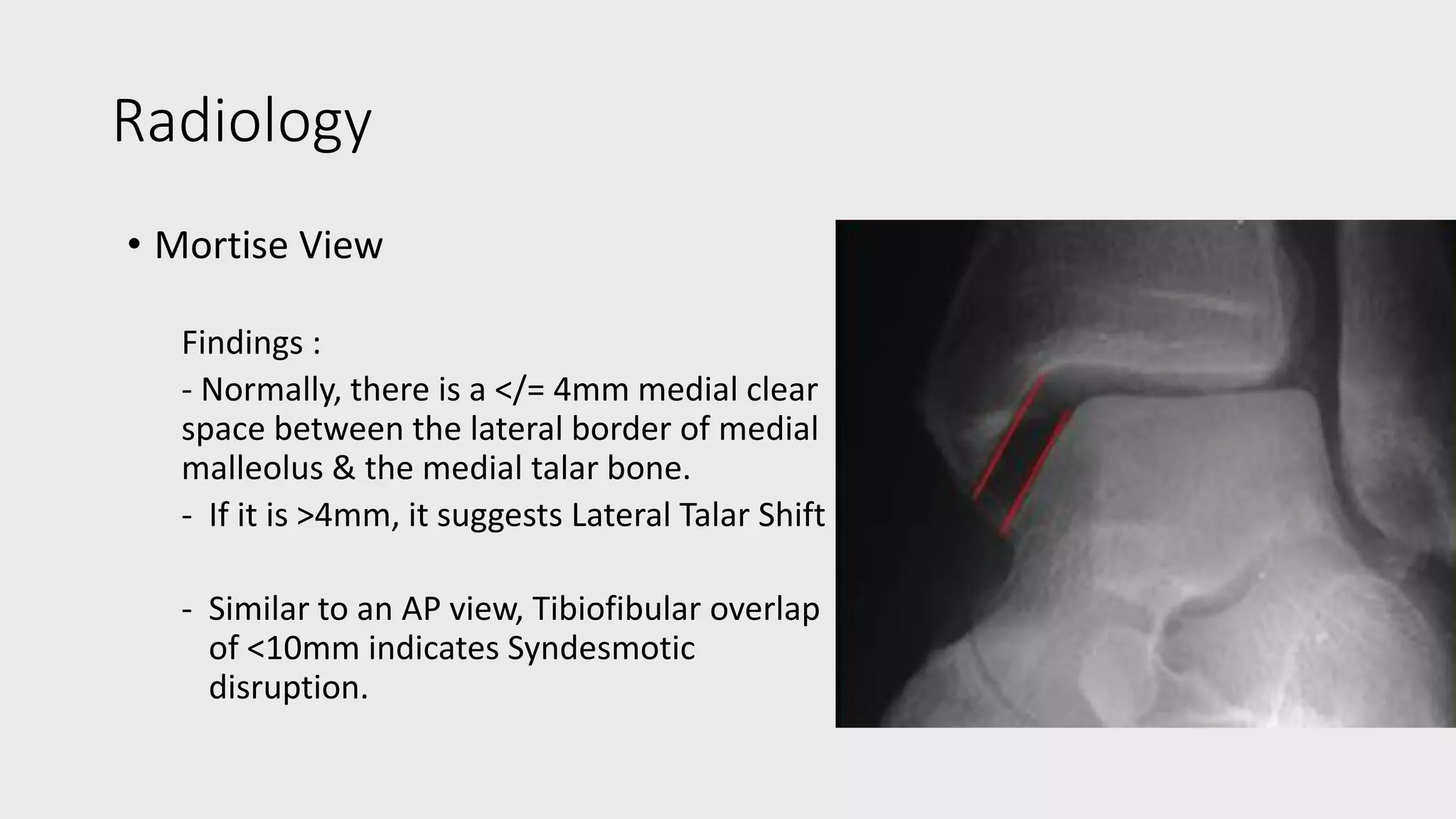 Ankle Fractures.pptx