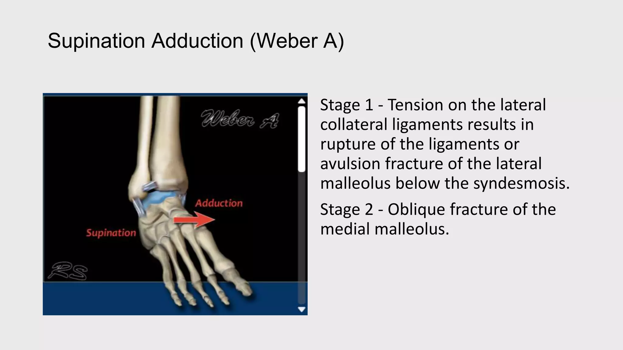 Ankle Fractures.pptx