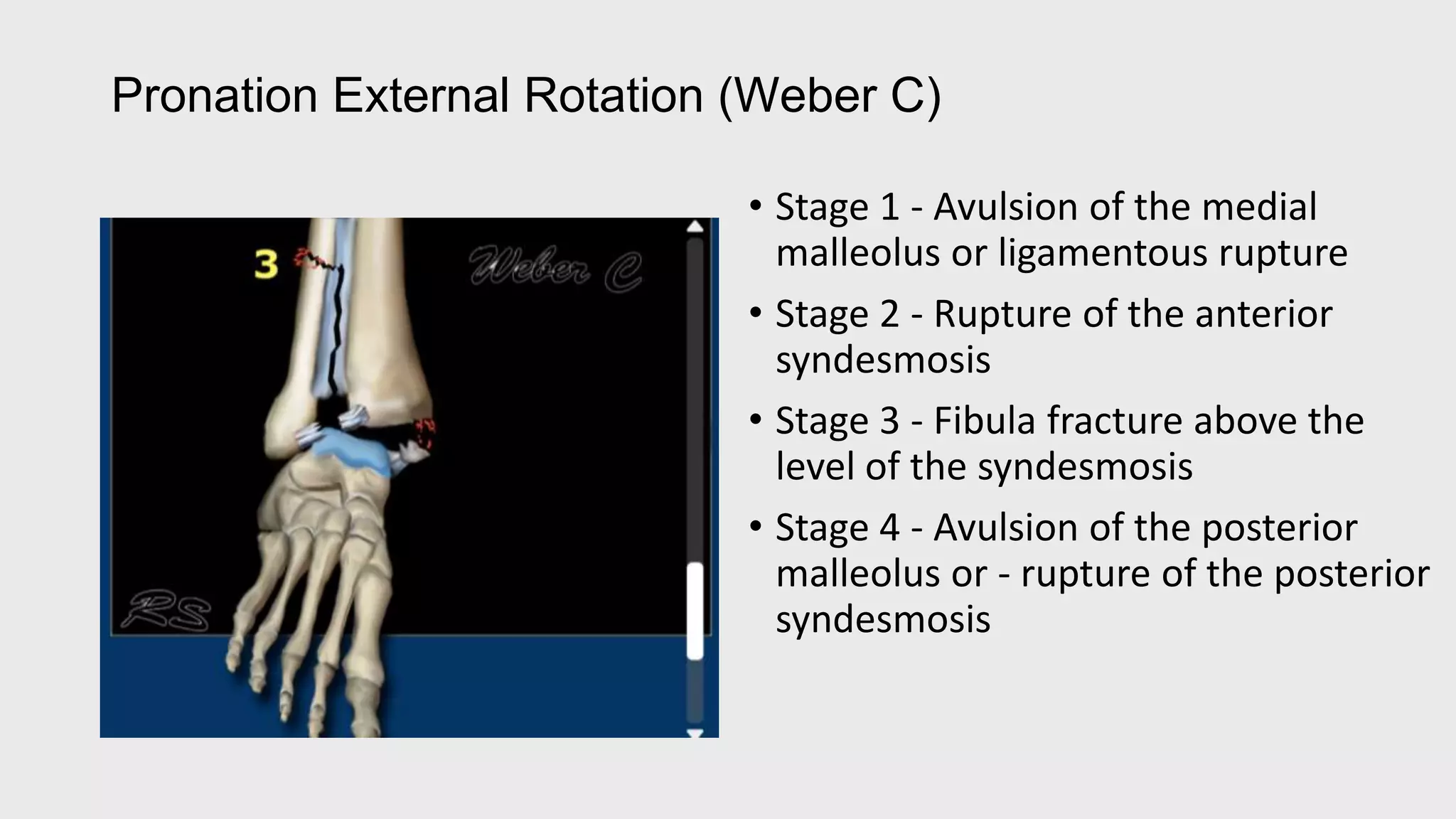 Ankle Fractures.pptx