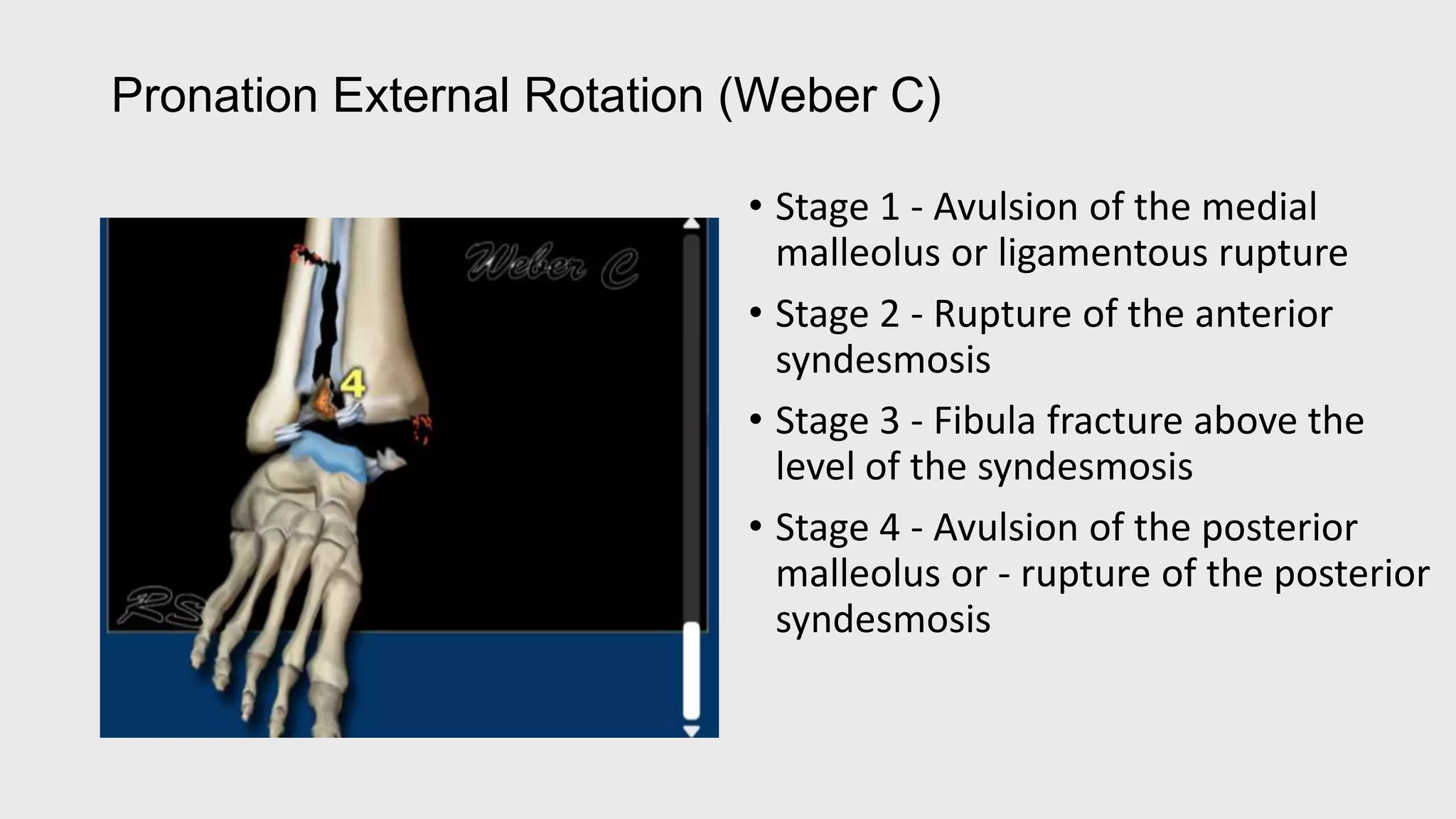 Ankle Fractures.pptx