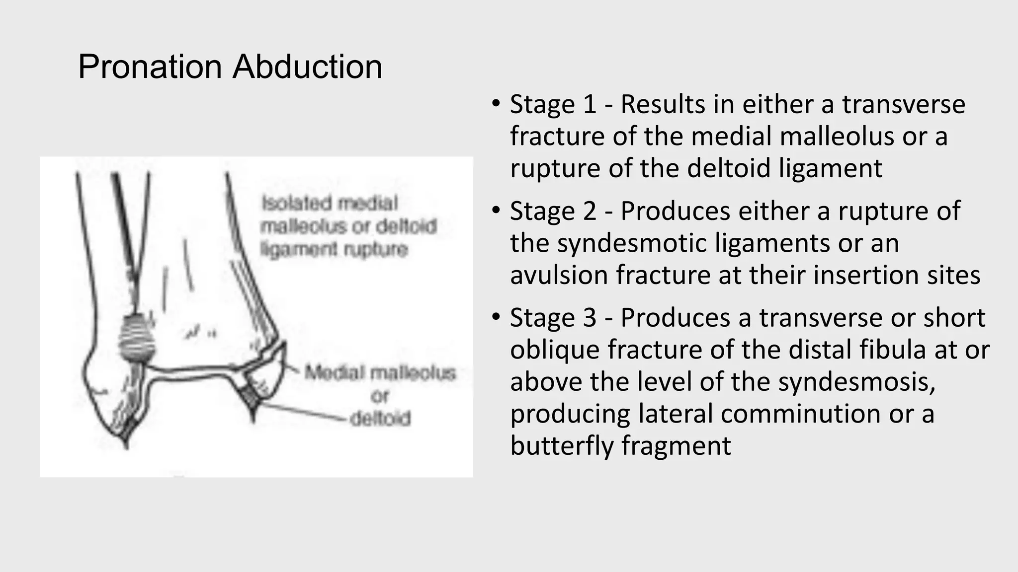 Ankle Fractures.pptx